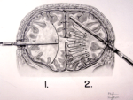 Dr. Walter Freeman’s photographs of lobotomy patients – h-madness